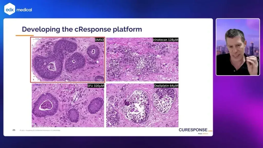 New ‘Super Test’ for Prostate Cancer – EDX Medical